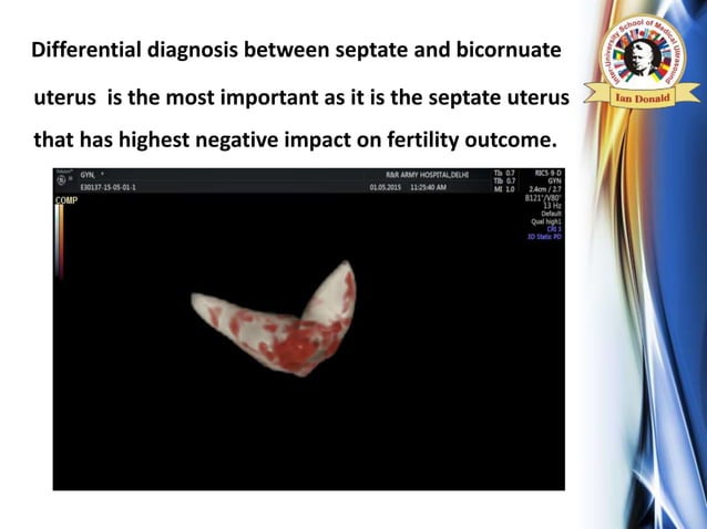 3d 4d Ultrasound In Uterine Septum Evaluation
