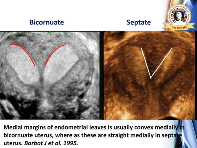 3d 4d Ultrasound In Uterine Septum Evaluation