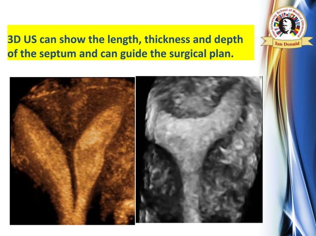 3D-4D ULTRASOUND IN UTERINE SEPTUM EVALUATION