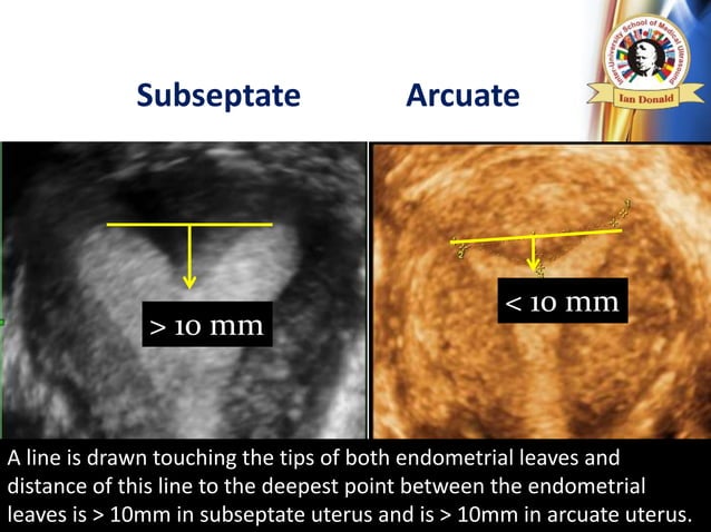 3D-4D ULTRASOUND IN UTERINE SEPTUM EVALUATION