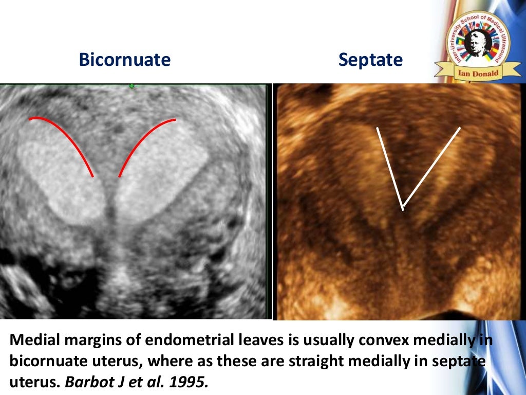 3D-4D ULTRASOUND IN UTERINE SEPTUM EVALUATION