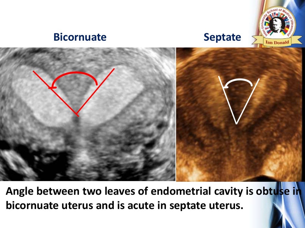 3D-4D ULTRASOUND IN UTERINE SEPTUM EVALUATION