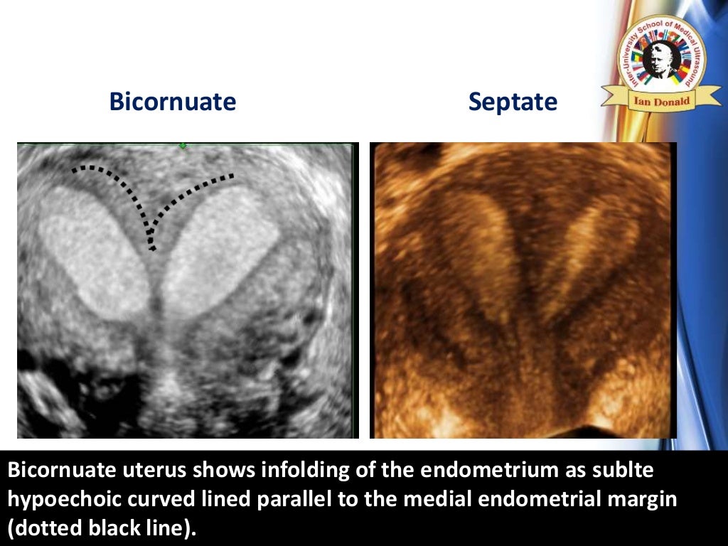 3D-4D ULTRASOUND IN UTERINE SEPTUM EVALUATION