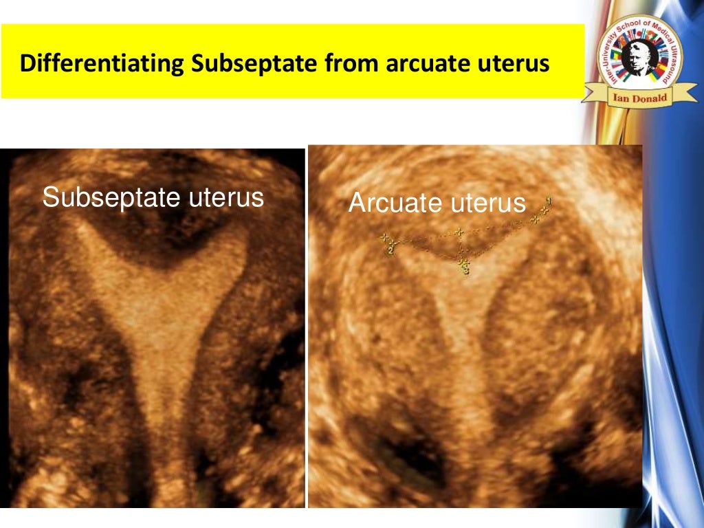 3D-4D ULTRASOUND IN UTERINE SEPTUM EVALUATION