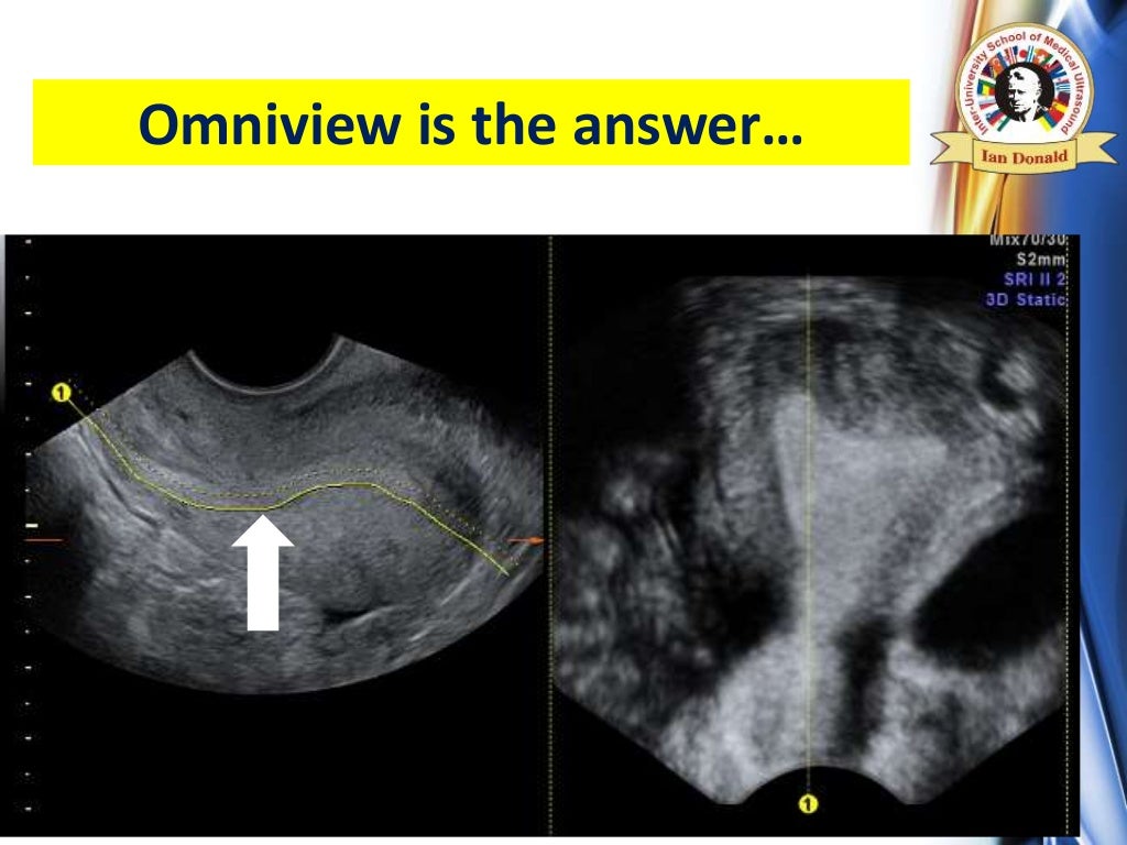 3D-4D ULTRASOUND IN UTERINE SEPTUM EVALUATION