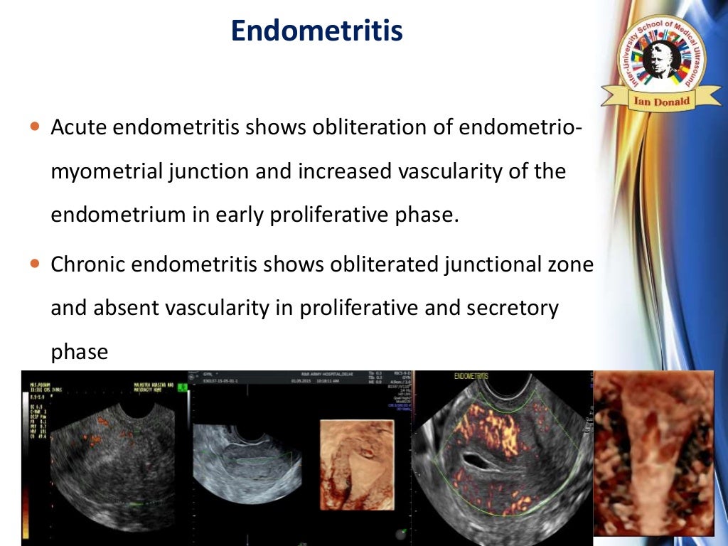 3d 4d Ultrasound In Uterine Septum Evaluation
