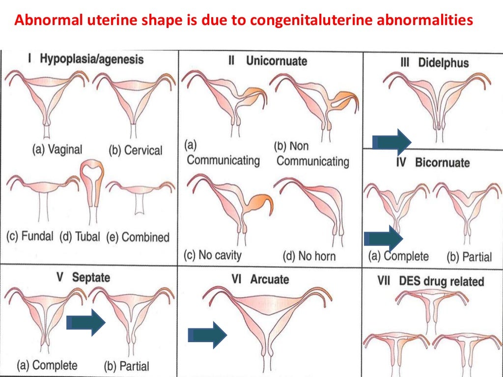 3D-4D ULTRASOUND IN UTERINE SEPTUM EVALUATION