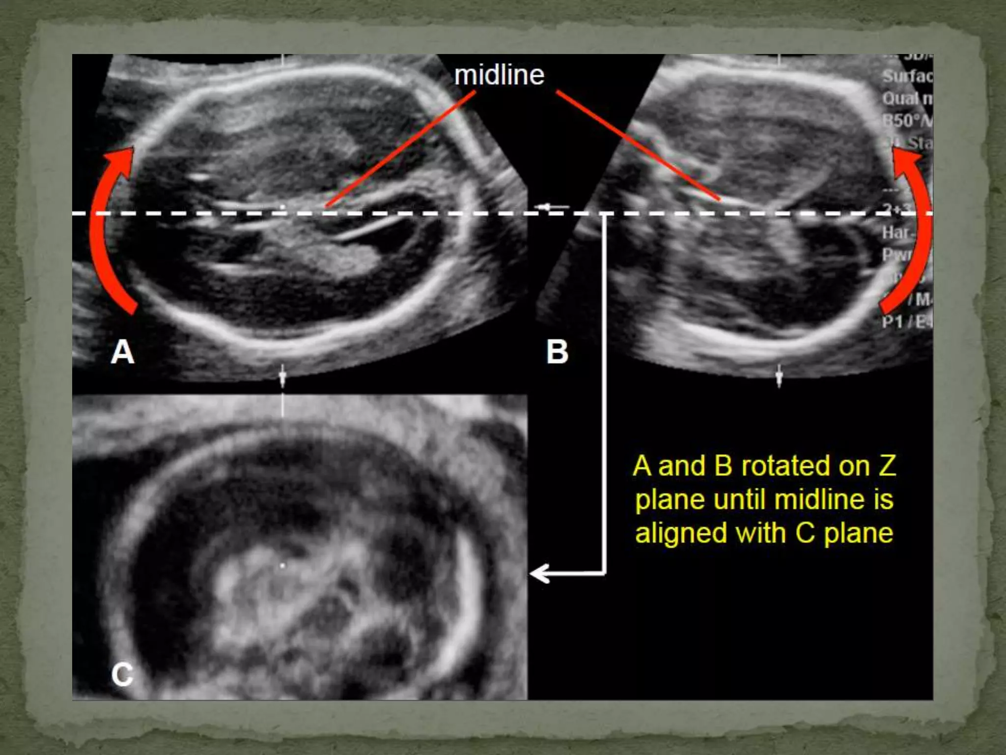 3D&4D brain anomalies | PPTX