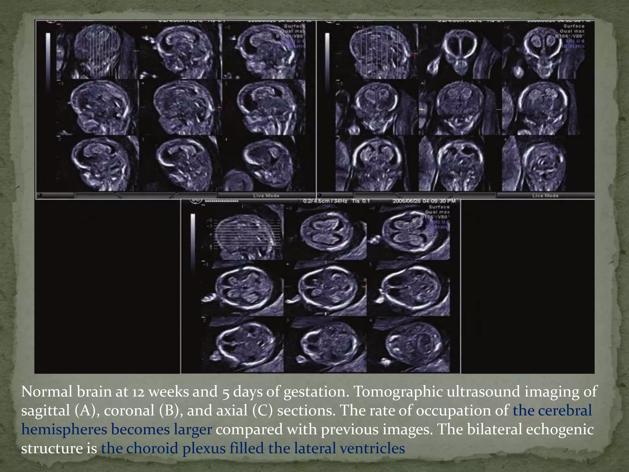 3D&4D brain anomalies | PPTX