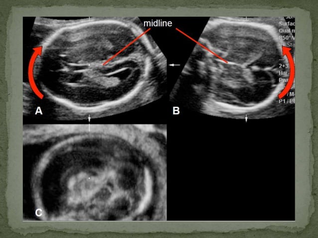3D&4D brain anomalies | PPTX