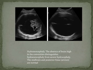 Hydranencephaly Ultrasound