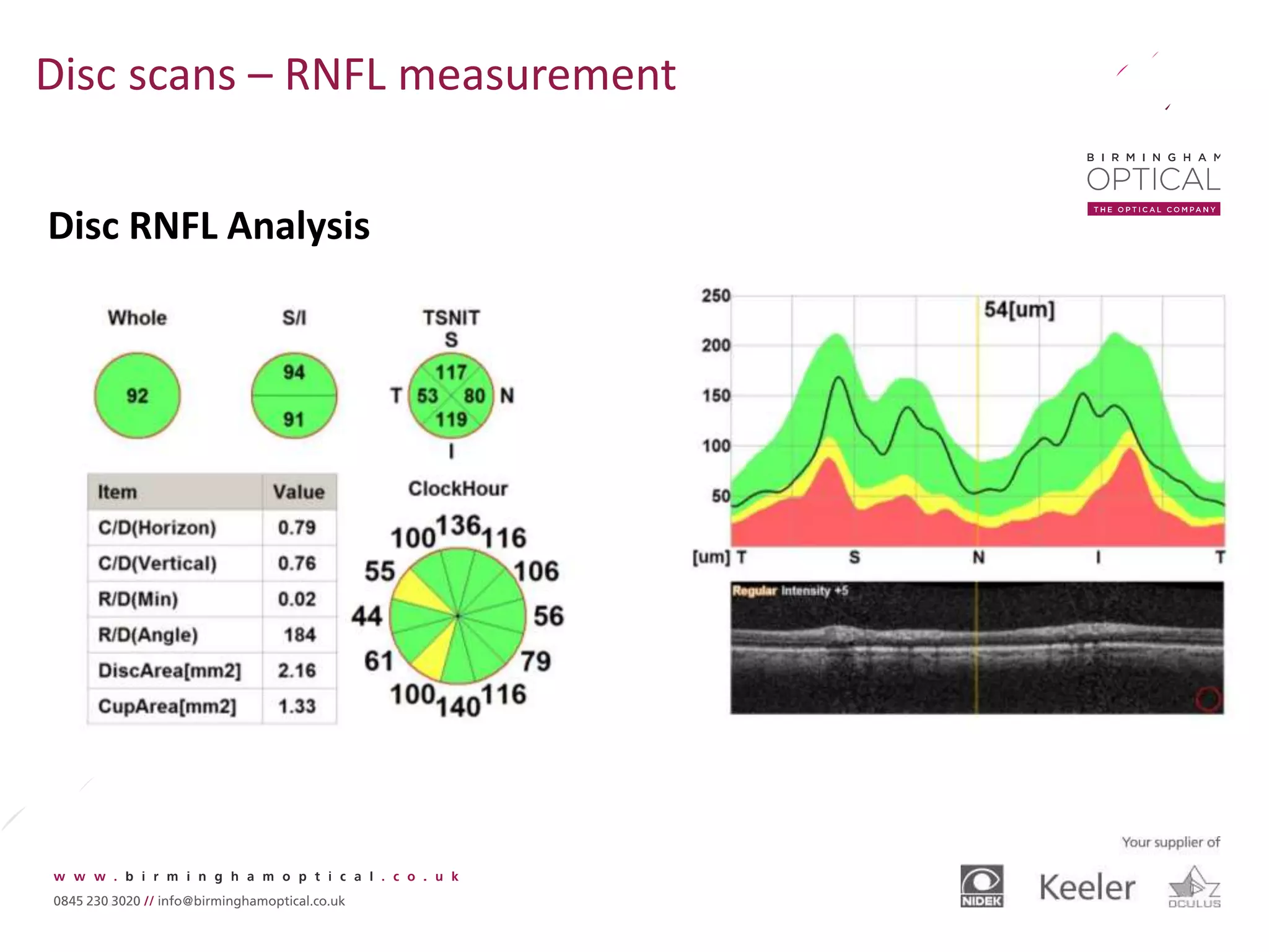 Glaucoma and OCT – Are Macula Scans More Valuable than Disc Scans | PPTX