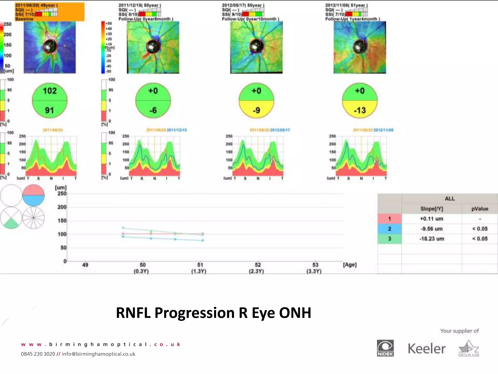 Glaucoma and OCT – Are Macula Scans More Valuable than Disc Scans | PPTX