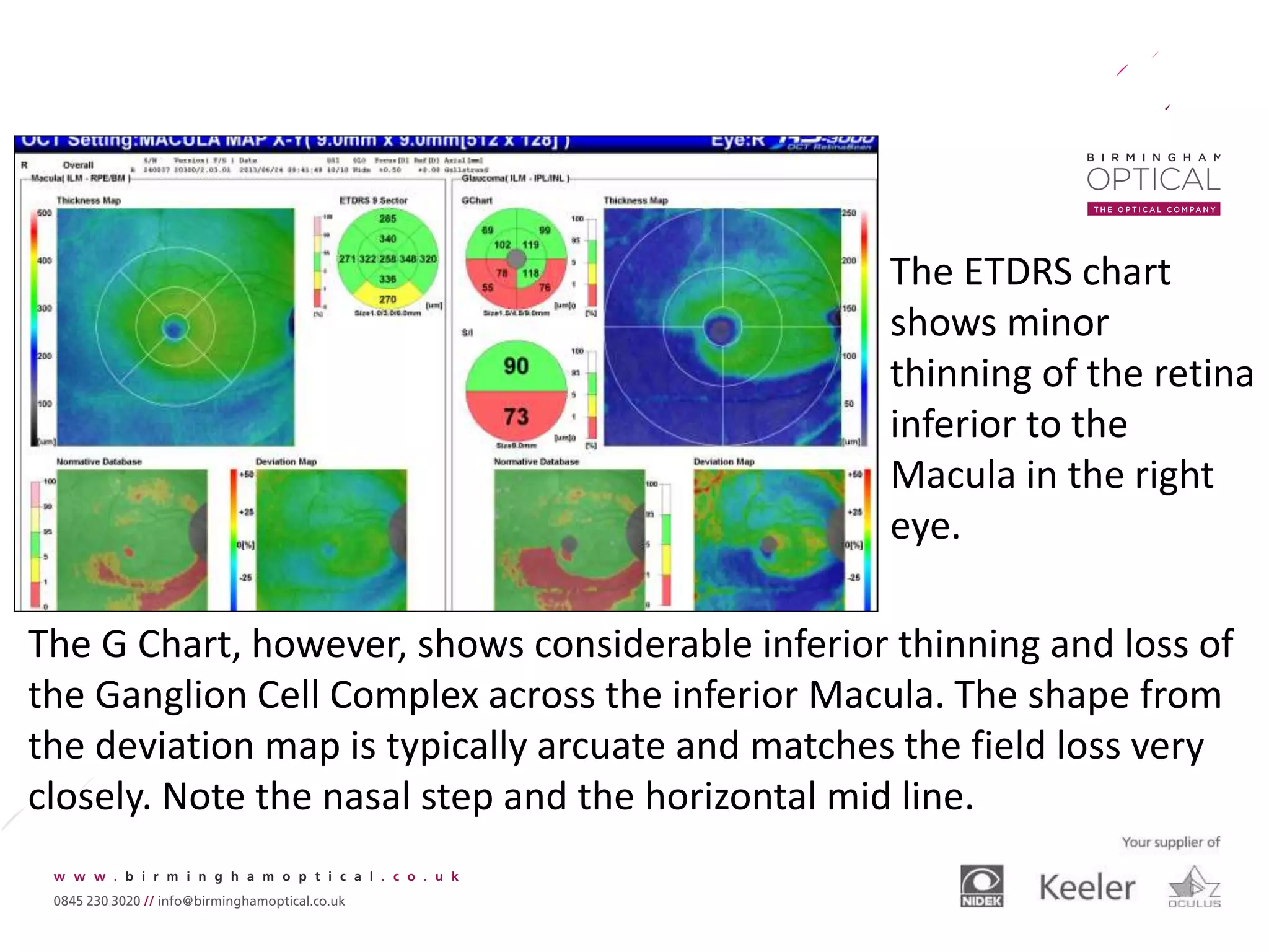 Glaucoma and OCT – Are Macula Scans More Valuable than Disc Scans | PPTX