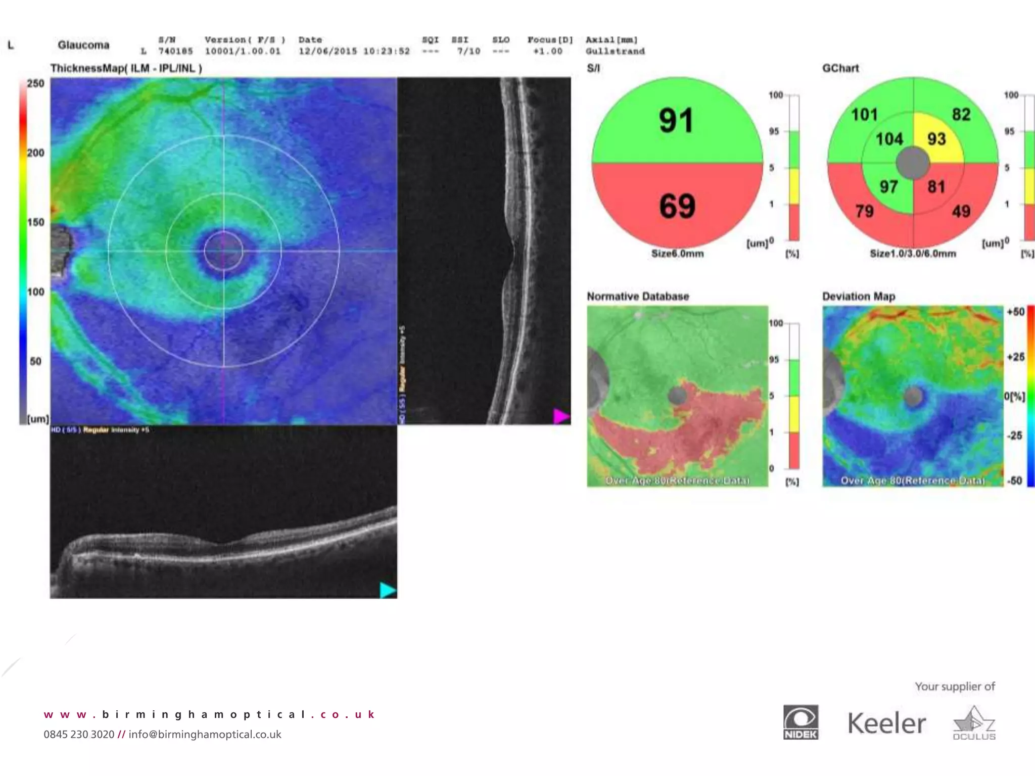 Glaucoma and OCT – Are Macula Scans More Valuable than Disc Scans | PPTX