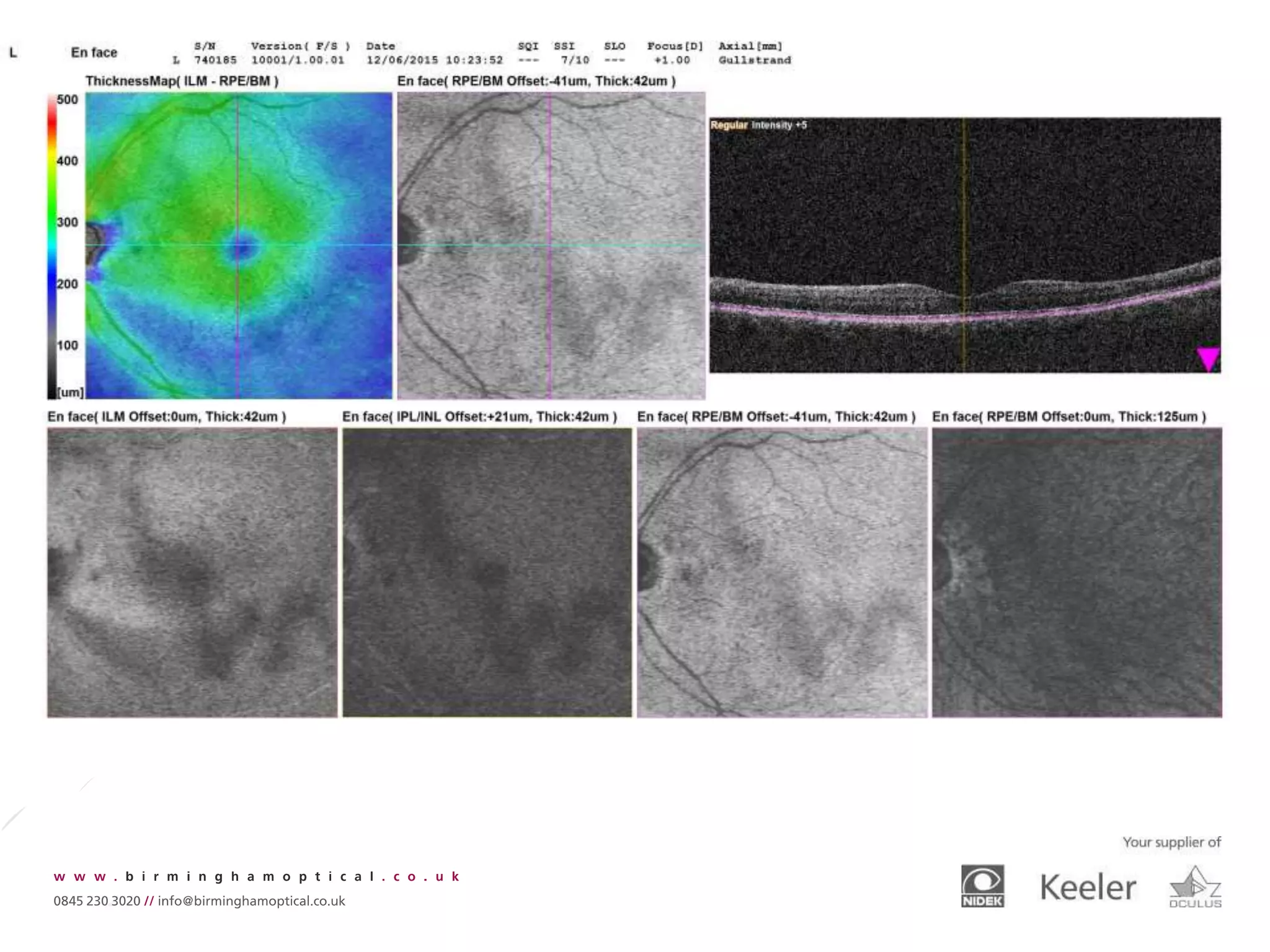 Glaucoma and OCT – Are Macula Scans More Valuable than Disc Scans | PPTX