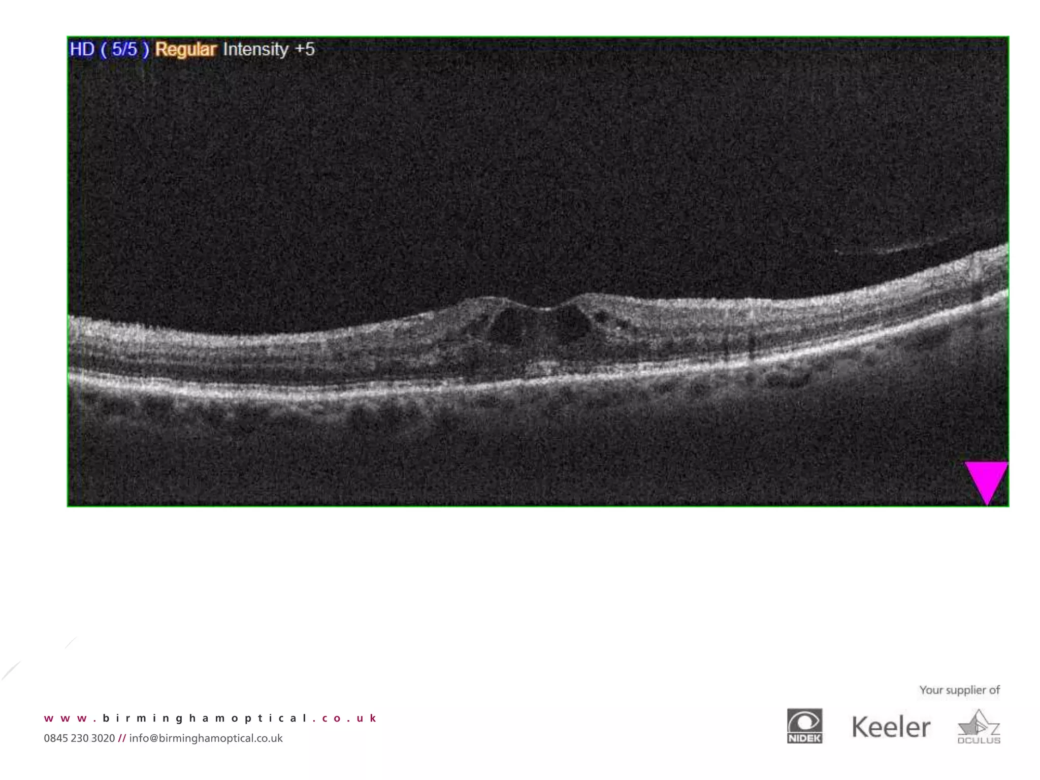 Glaucoma and OCT – Are Macula Scans More Valuable than Disc Scans | PPTX