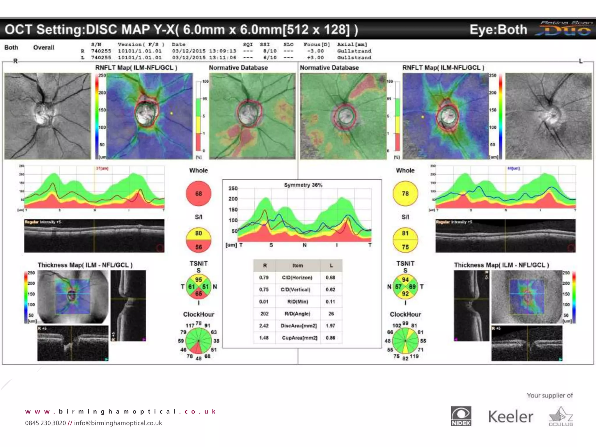 Glaucoma and OCT – Are Macula Scans More Valuable than Disc Scans | PPTX