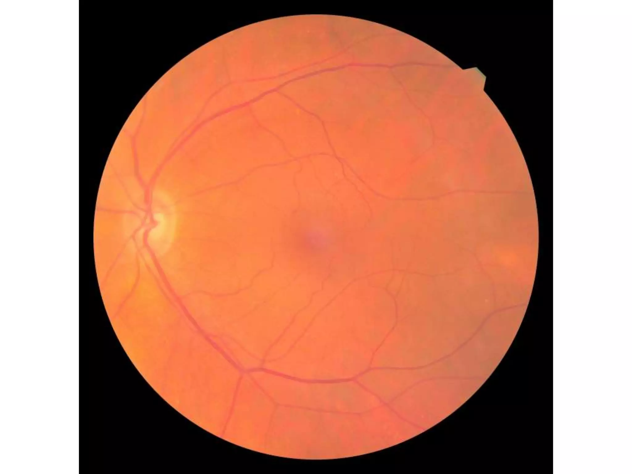 Glaucoma and OCT – Are Macula Scans More Valuable than Disc Scans | PPTX
