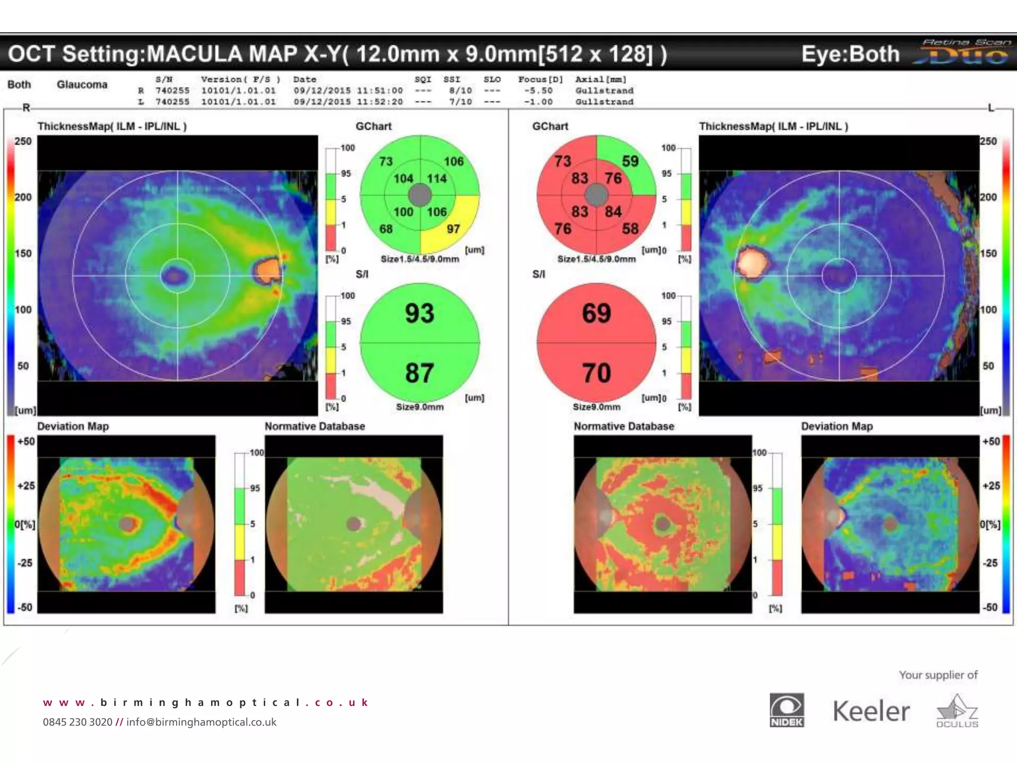 Glaucoma and OCT – Are Macula Scans More Valuable than Disc Scans | PPTX