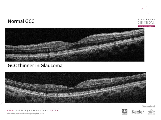 Glaucoma and OCT – Are Macula Scans More Valuable than Disc Scans | PPTX