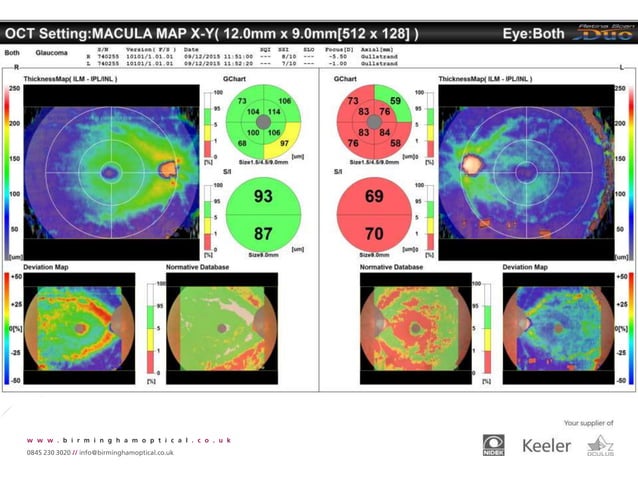 Glaucoma and OCT – Are Macula Scans More Valuable than Disc Scans | PPTX