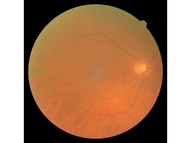 Glaucoma and OCT – Are Macula Scans More Valuable than Disc Scans | PPTX
