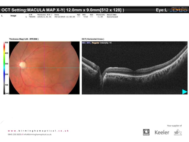 Glaucoma and OCT – Are Macula Scans More Valuable than Disc Scans | PPTX