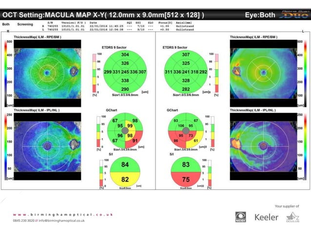 Glaucoma and OCT – Are Macula Scans More Valuable than Disc Scans | PPTX