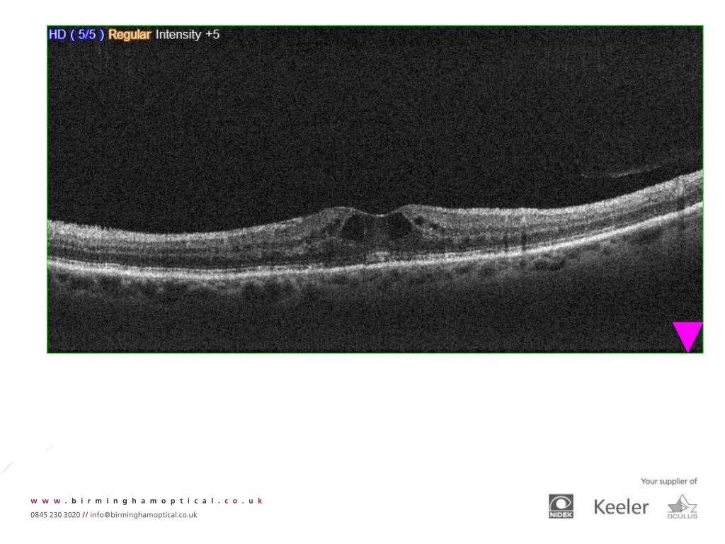 Glaucoma and OCT – Are Macula Scans More Valuable than Disc Scans