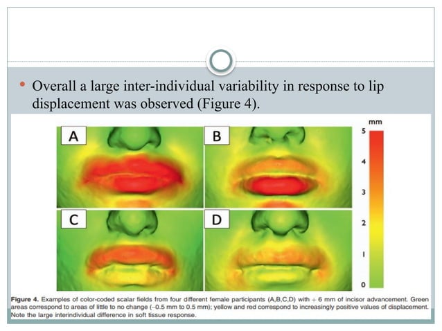 Three dimensional Analysus of lip changes in response to simulated maxillary incisor advancement ...