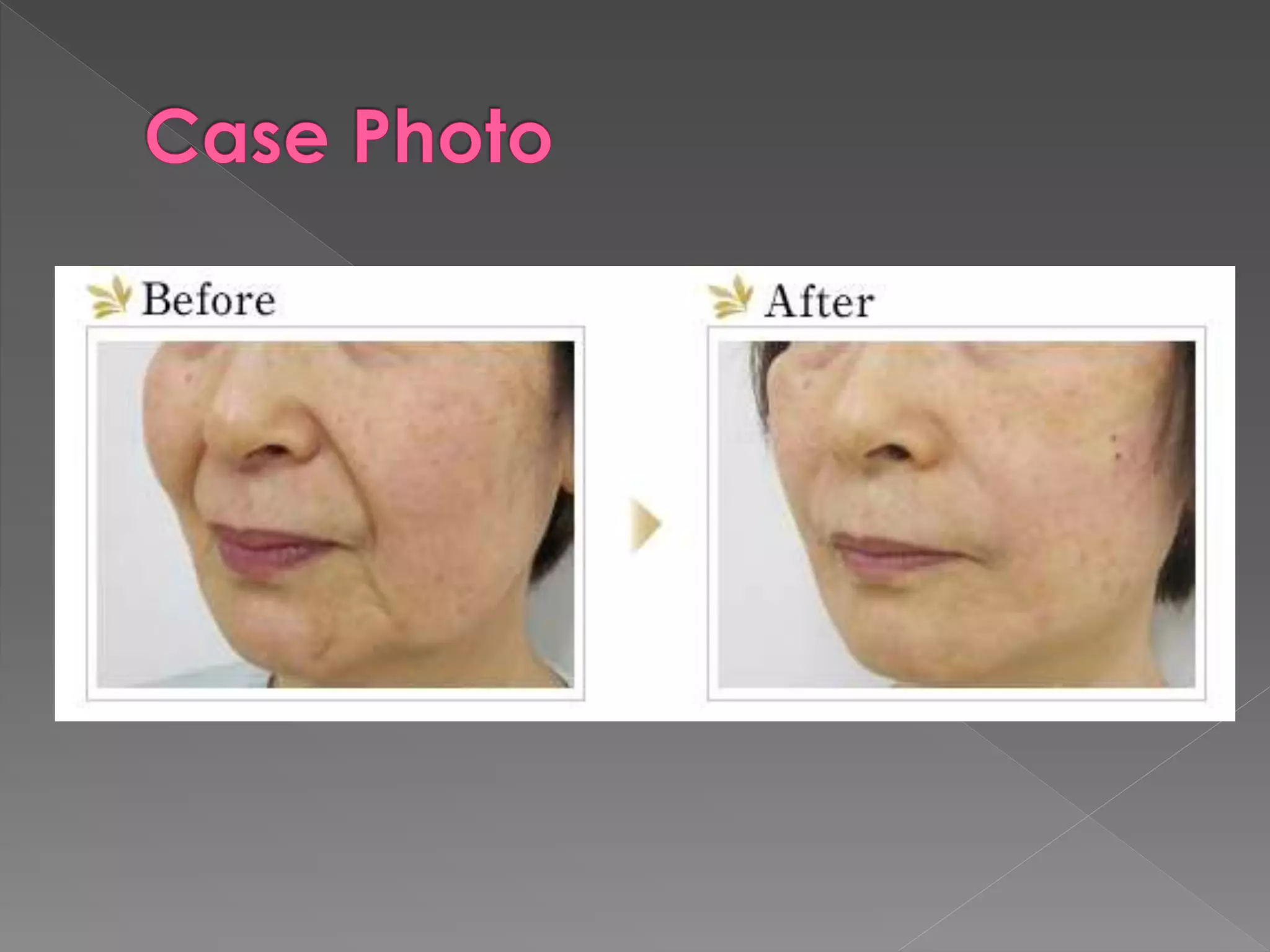 Non-surgical Facelift - 3D Angel Lift | PPTX