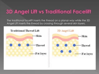 Non-surgical Facelift - 3D Angel Lift | PPTX | Skin Care | Beauty
