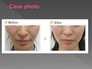 Non-surgical Facelift - 3D Angel Lift | PPTX | Skin Care | Beauty