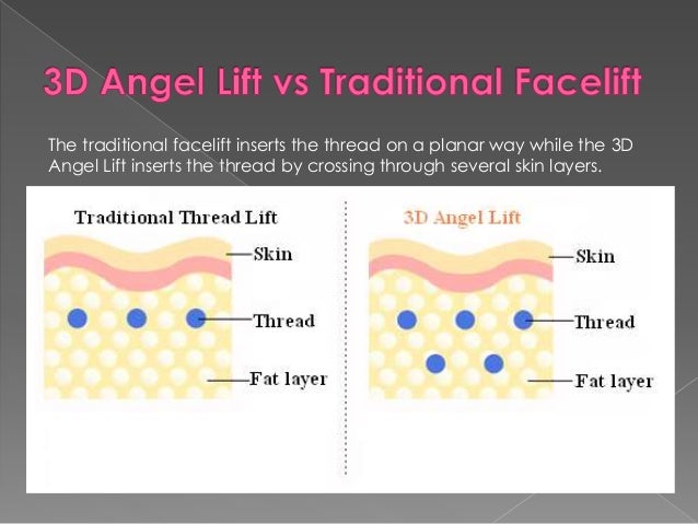 Non-surgical Facelift - 3D Angel Lift