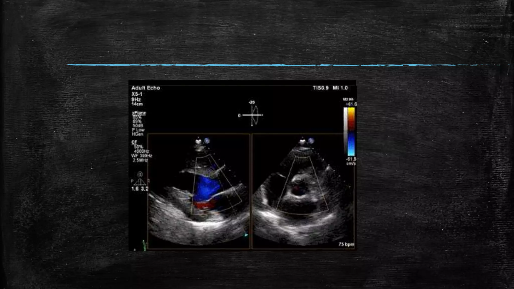 3D Echocardiography | PPTX