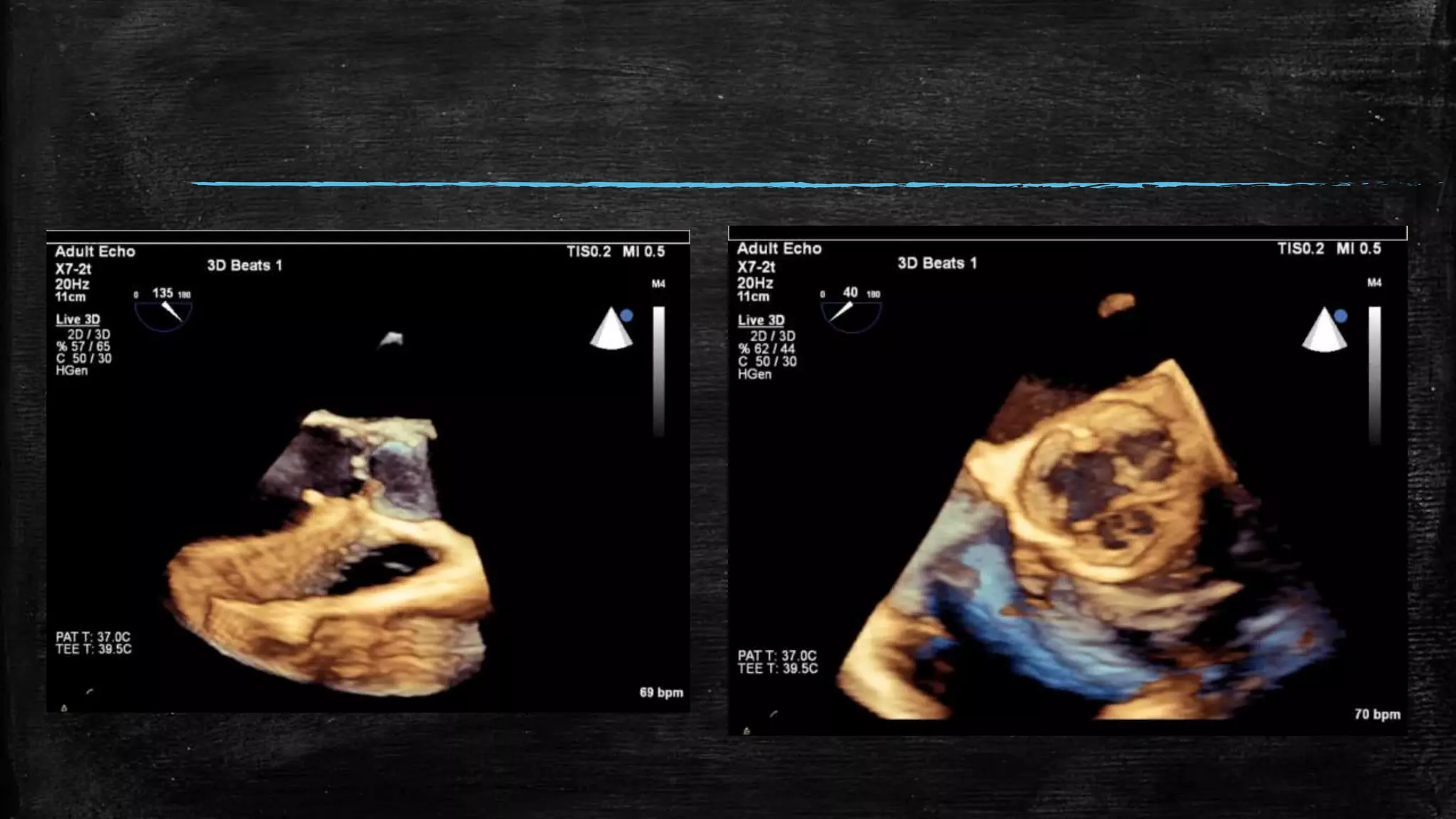 3D Echocardiography | PPTX
