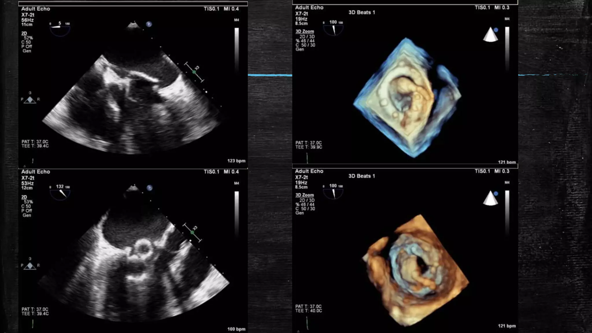 3D Echocardiography | PPTX