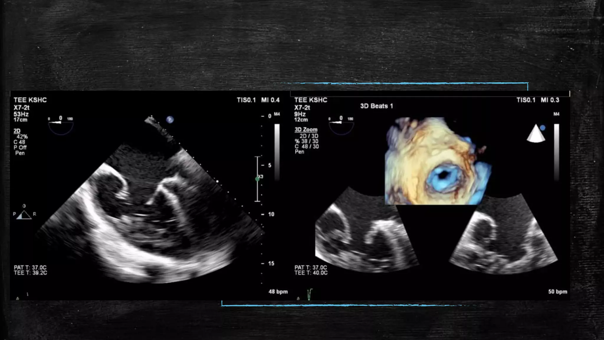 Qu’est-Ce Que L’échocardiographie 3D – XNCUC