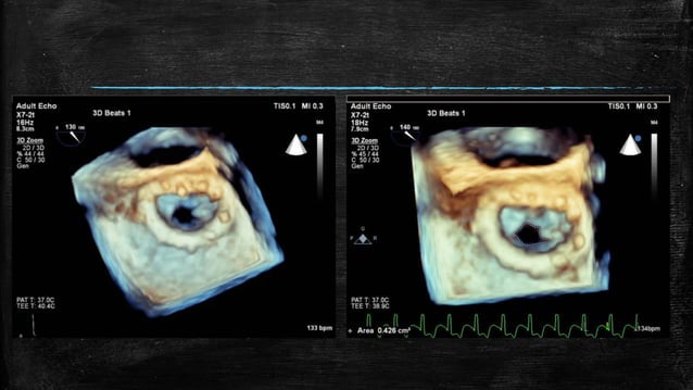 3D Echocardiography | PPTX