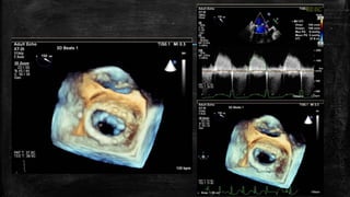 3D Echocardiography | PPTX