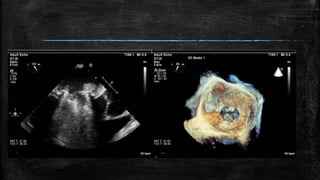 3D Echocardiography | PPTX