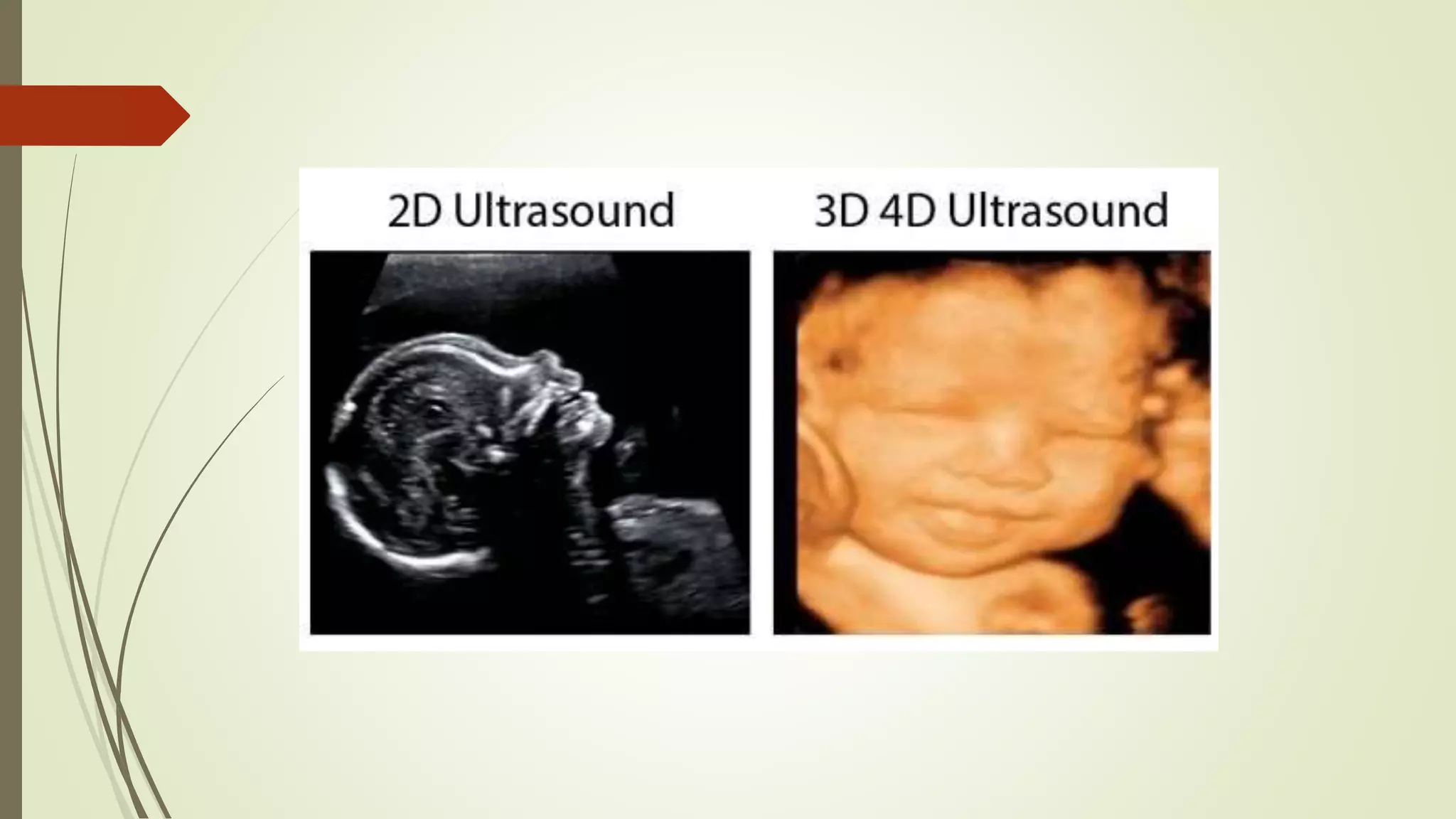 3D Baby Scan | PPT