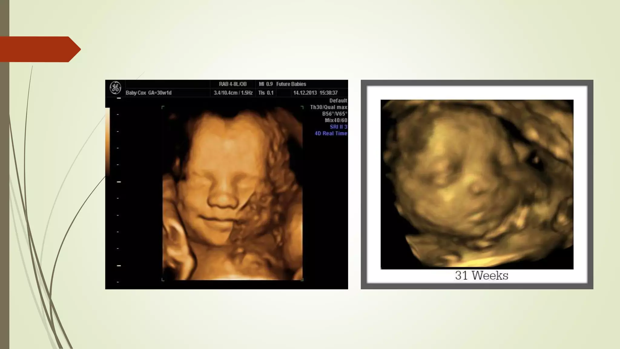 3D Baby Scan | PPT