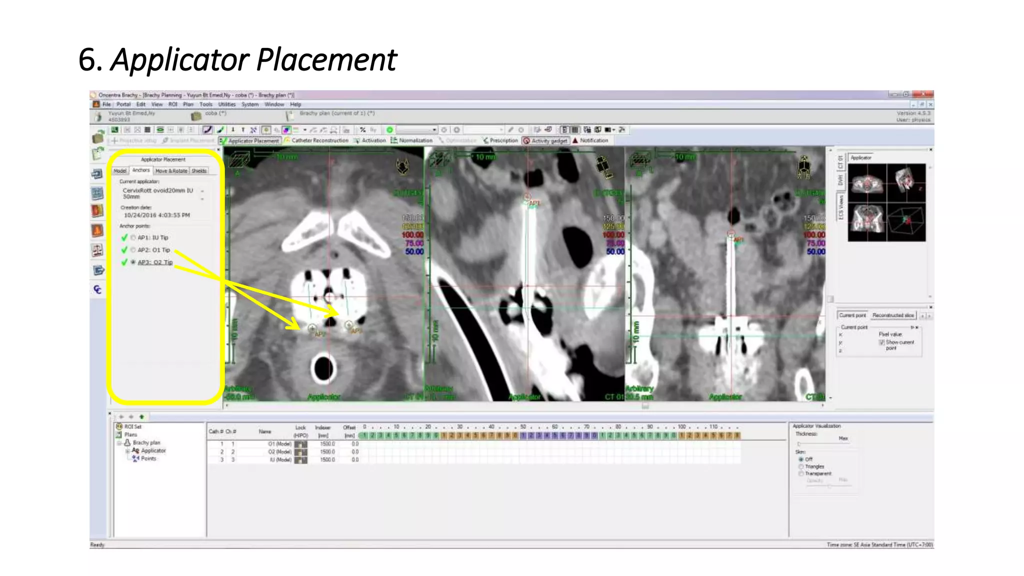 3D brachy planning.pptx