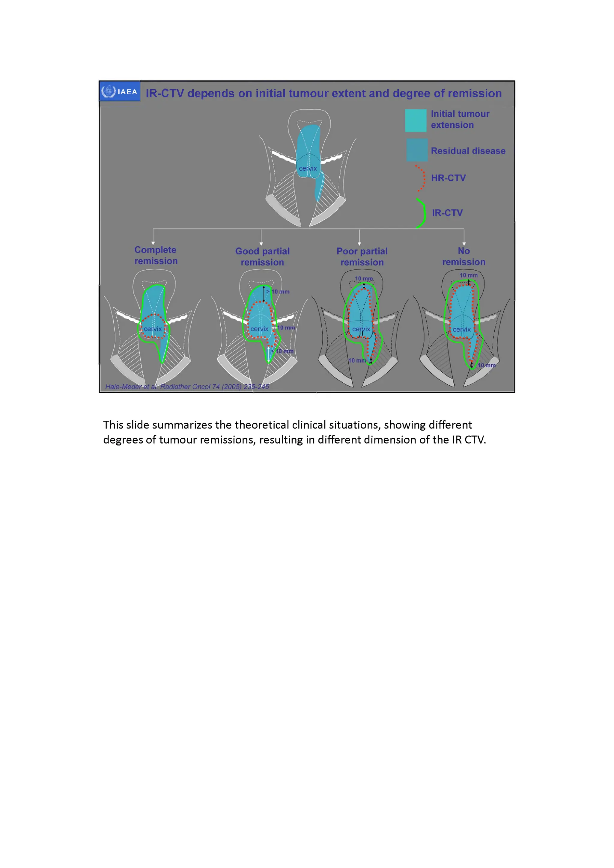 3D brachytherapy - definition and delineation of the target volumes ...