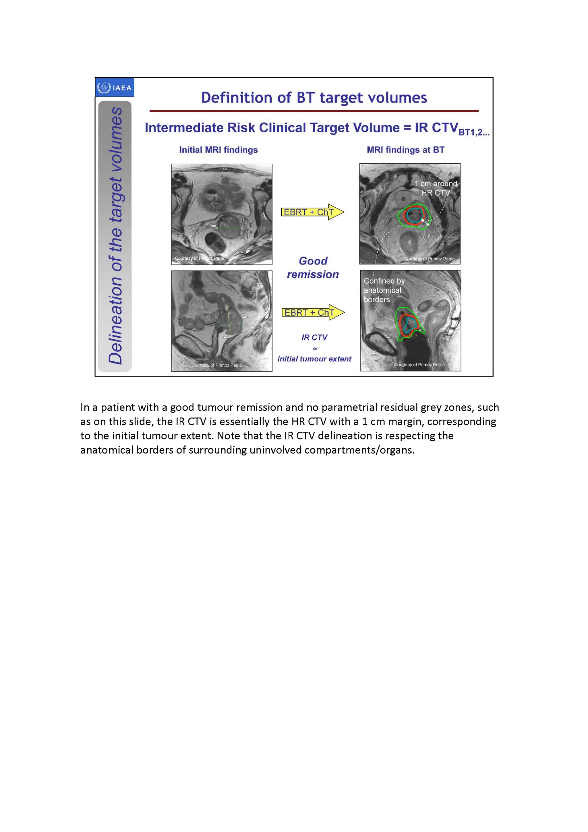 3D brachytherapy - definition and delineation of the target volumes ...