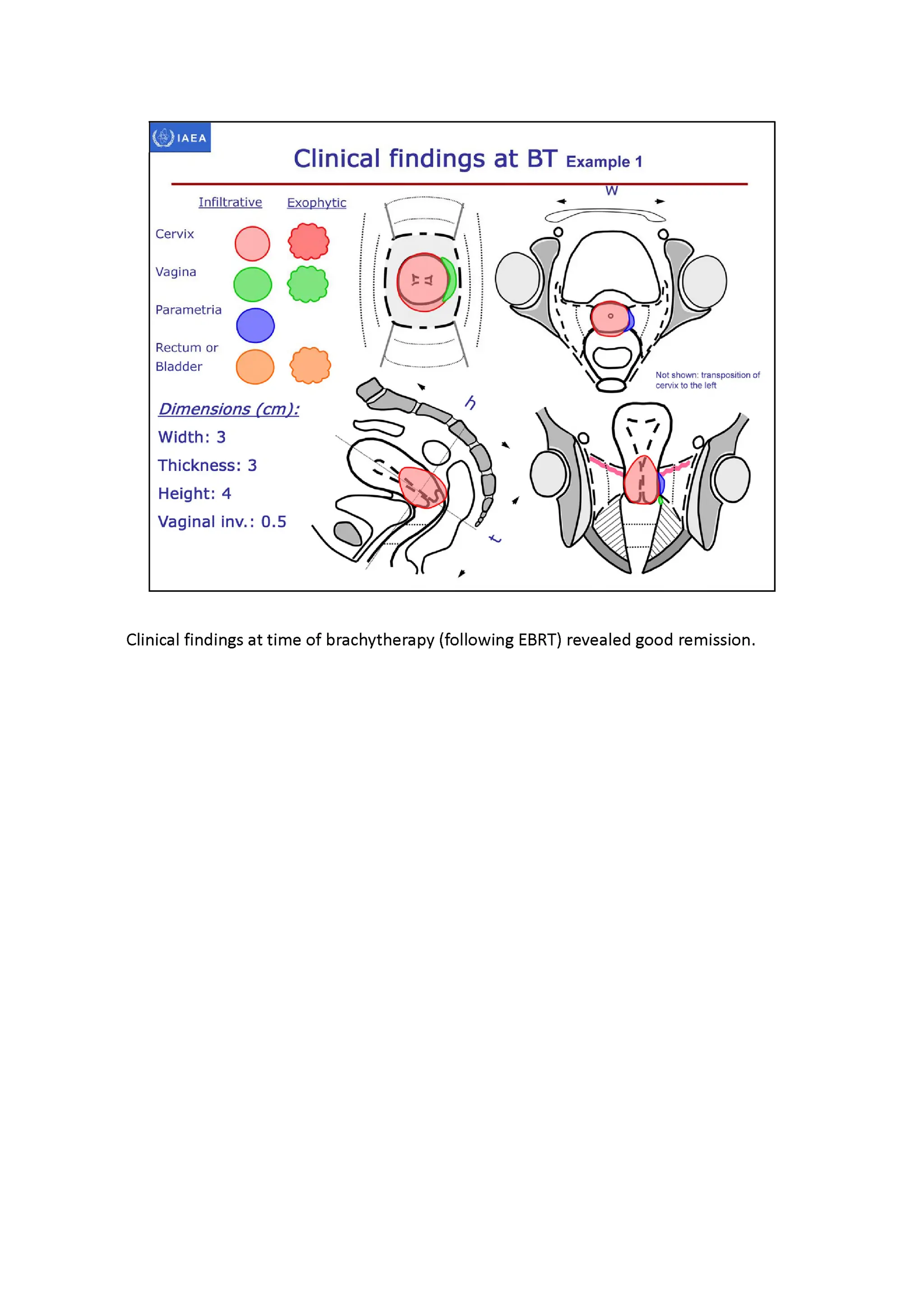 3D brachytherapy - definition and delineation of the target volumes ...