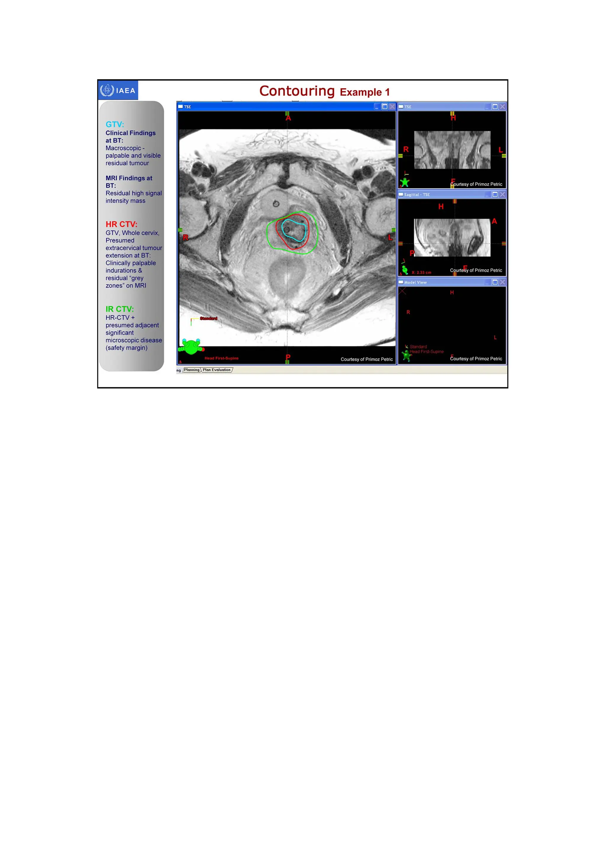 3D brachytherapy - definition and delineation of the target volumes ...