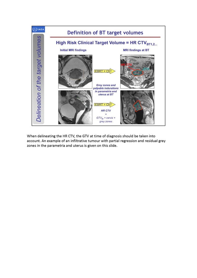 3D brachytherapy - definition and delineation of the target volumes ...